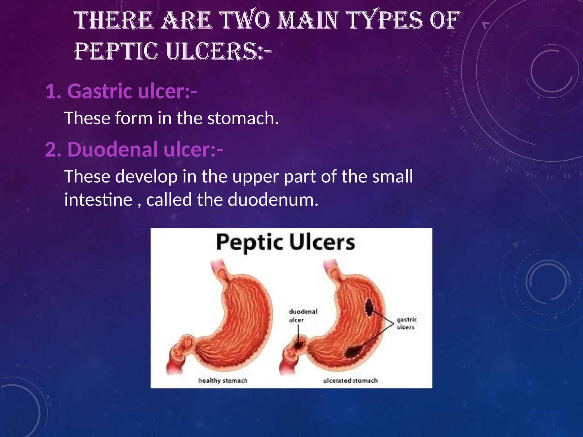 Peptic Ulcer: Types, Treatment, Drug Classification, Mechanism of Action & Side Effects | PPTX