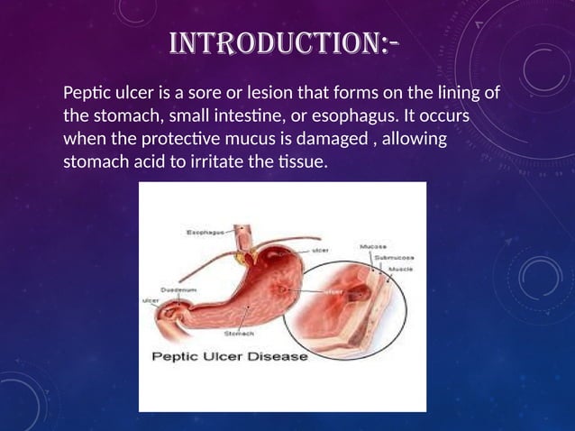 Peptic Ulcer: Types, Treatment, Drug Classification, Mechanism of ...