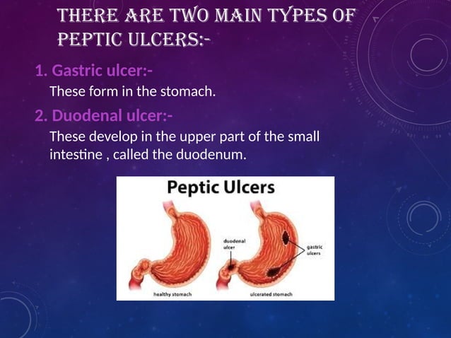 Peptic Ulcer: Types, Treatment, Drug Classification, Mechanism of ...