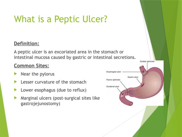 peptic ulcers introductory lecture .pptx