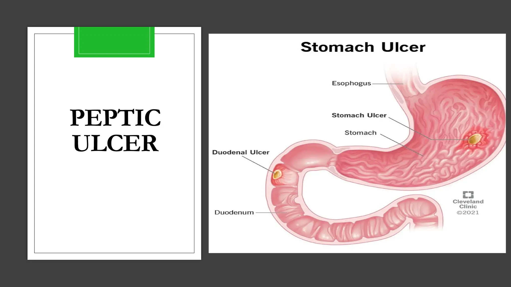 Peptic Ulcer along with their pathology and types | PPTX