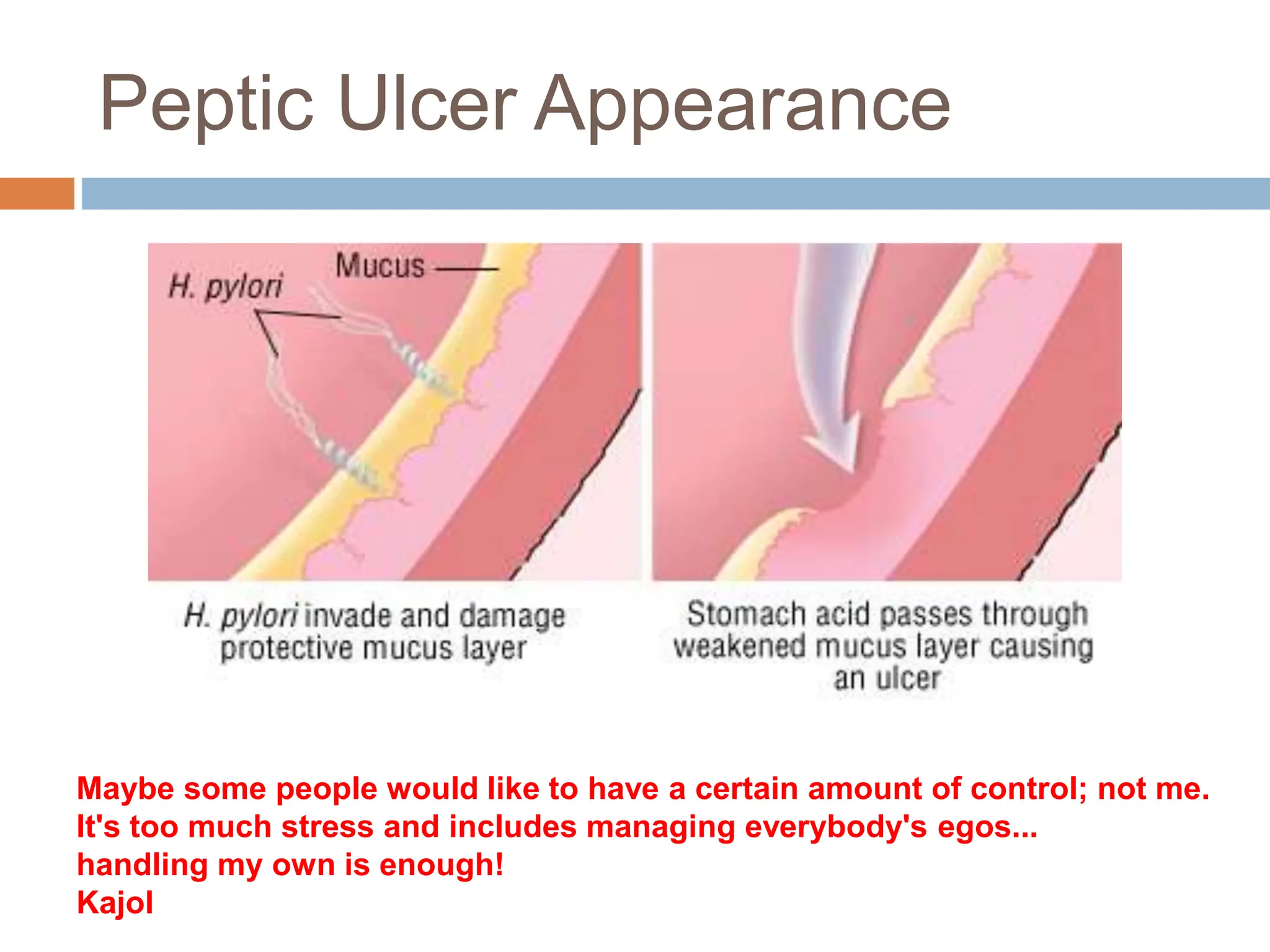 Peptic Ulcer.pptx | Digestive Disorders | Diseases and Conditions