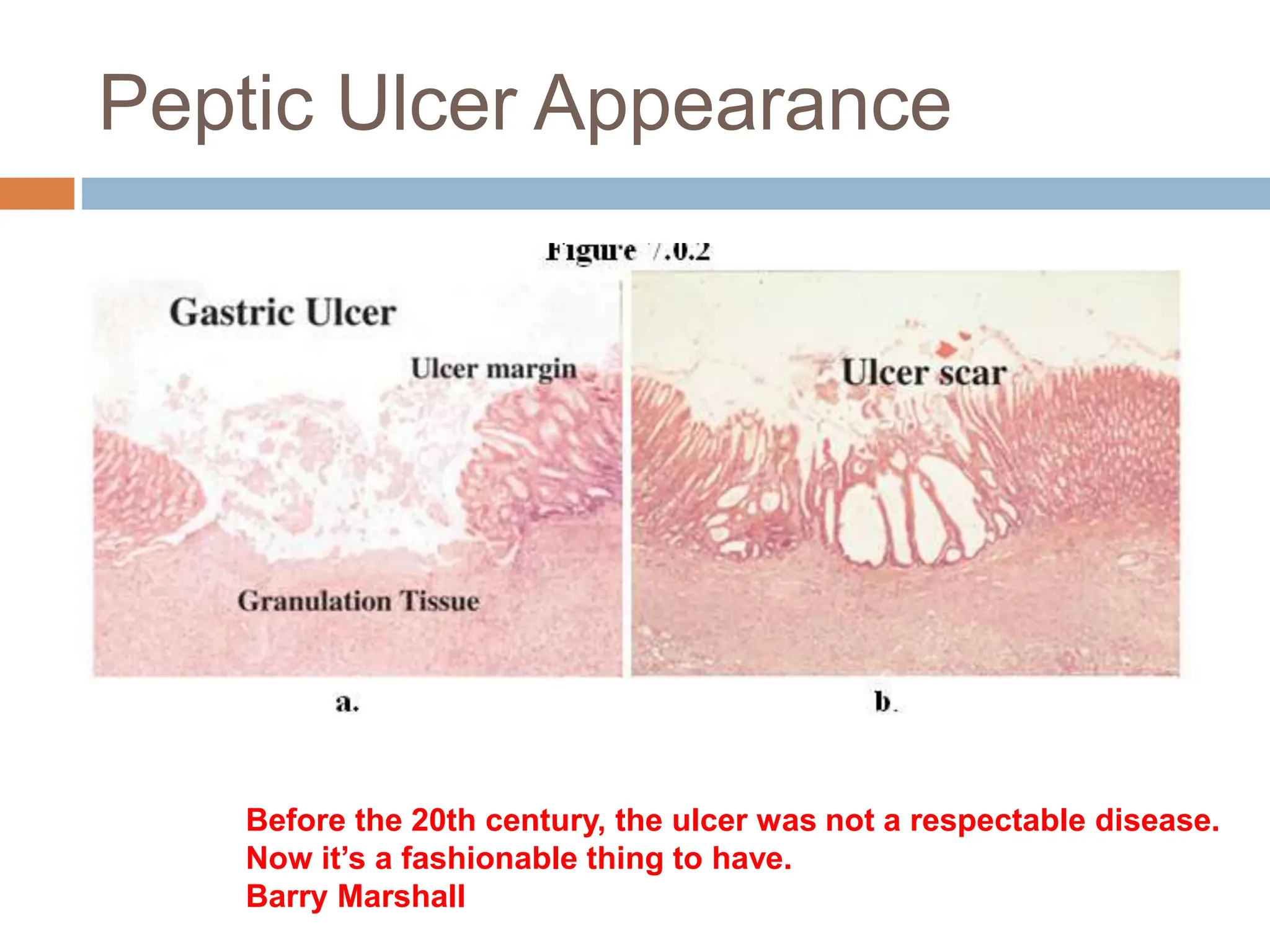 Peptic Ulcer.pptx | Digestive Disorders | Diseases and Conditions