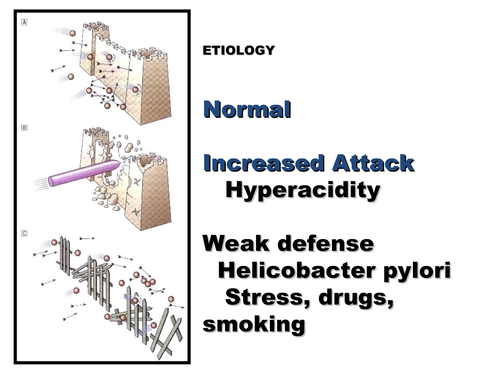 Peptic ulcer-intro, major factors, goal of treatments | PPT
