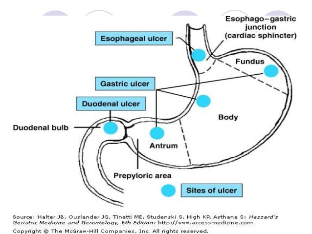 Peptic ulcer.