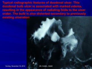 Peptic ulcer. rubel ppt | PPT