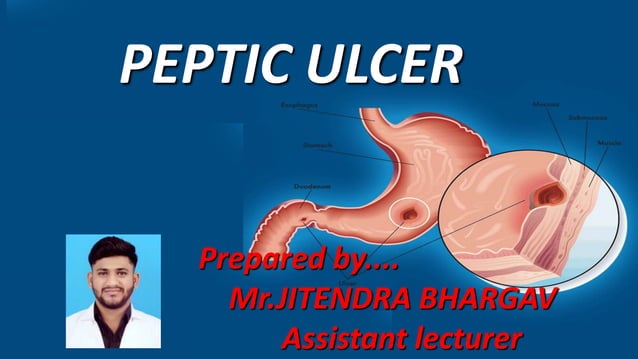PEPTIC ULCER SLIDESHARE | PPTX | Digestive Disorders | Diseases and ...