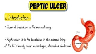 PEPTIC ULCER SLIDESHARE | PPTX
