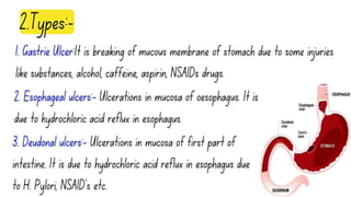 PEPTIC ULCER SLIDESHARE | PPTX