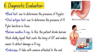 PEPTIC ULCER SLIDESHARE | PPTX