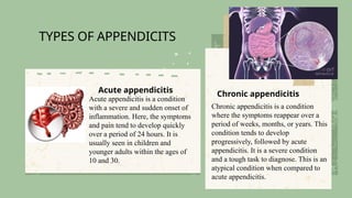 Peptic ulcer and Appendicits.pptx that is it so do not worry | PPTX