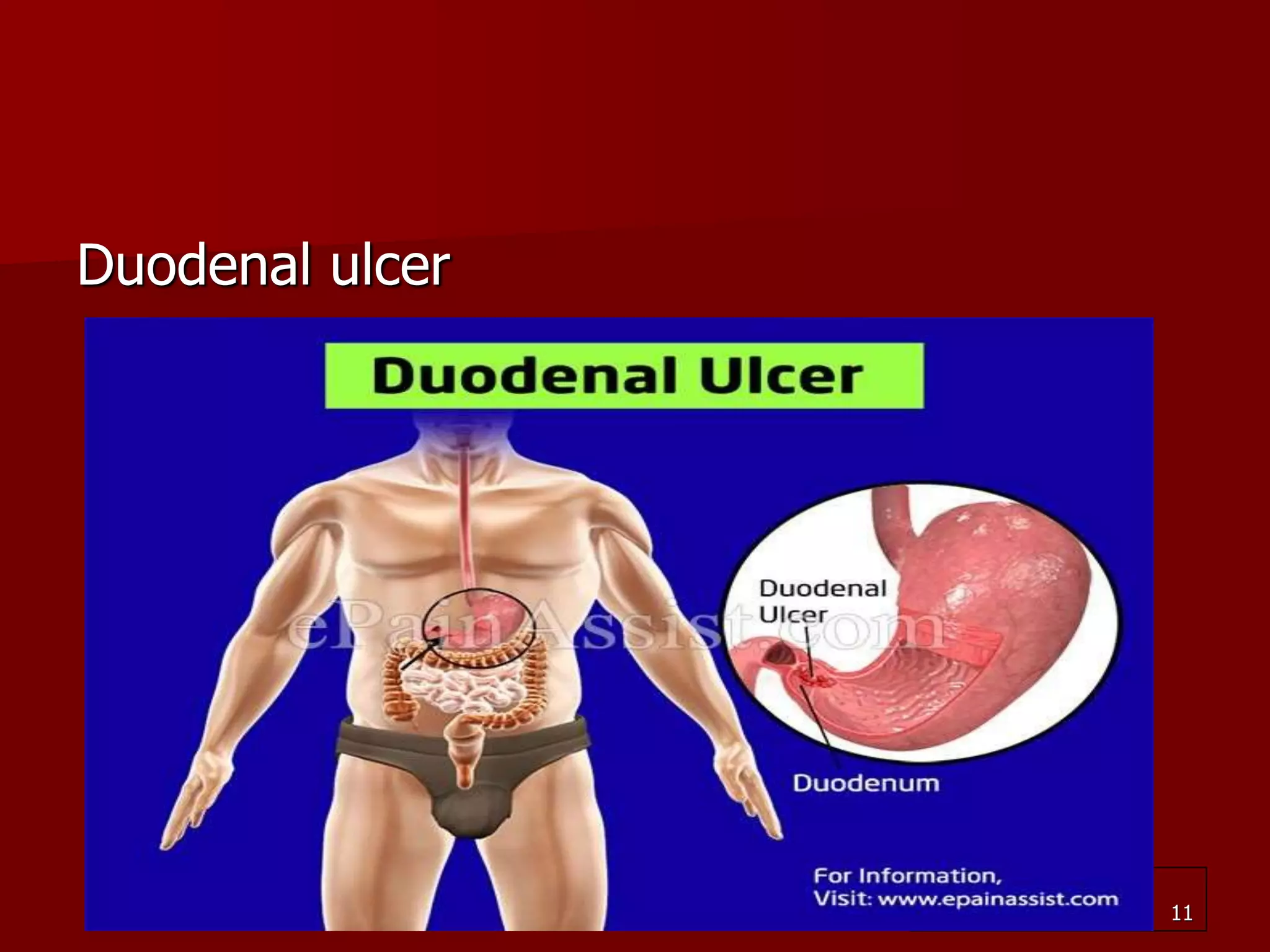 Peptic ulcer and duodenal ulcer ppt2 | PPT