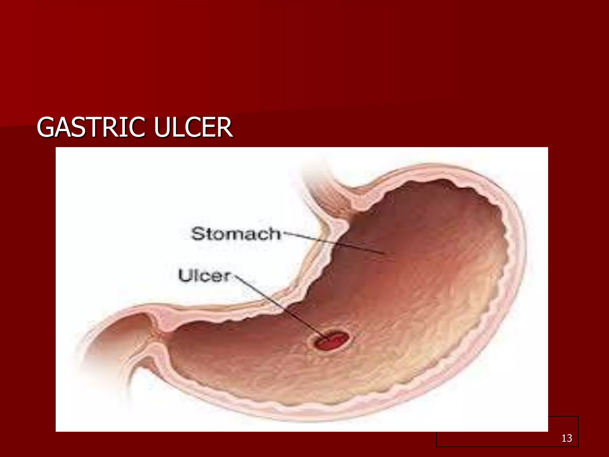 Peptic ulcer and duodenal ulcer ppt2 | PPT
