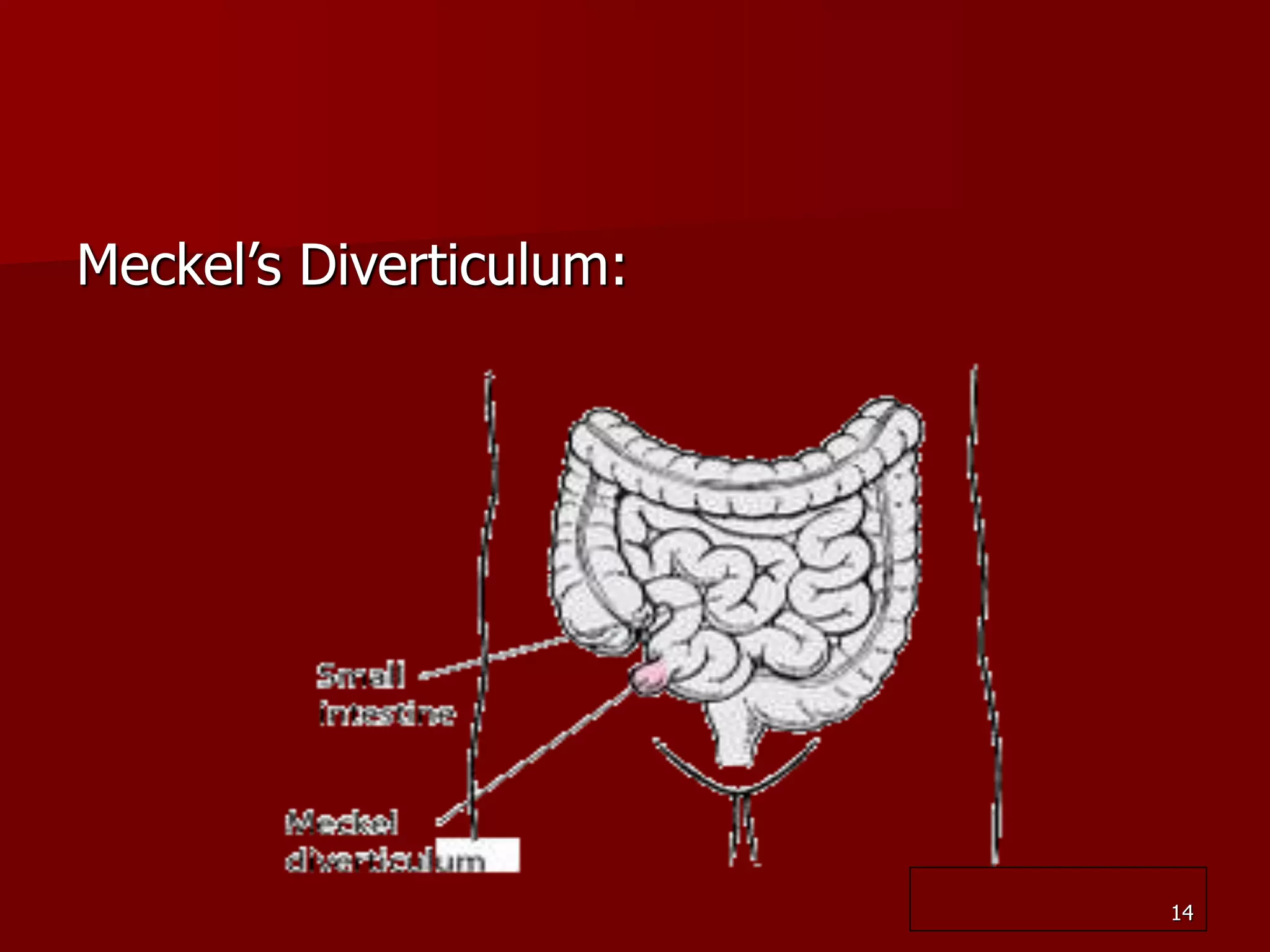 Peptic ulcer and duodenal ulcer ppt2 | PPT