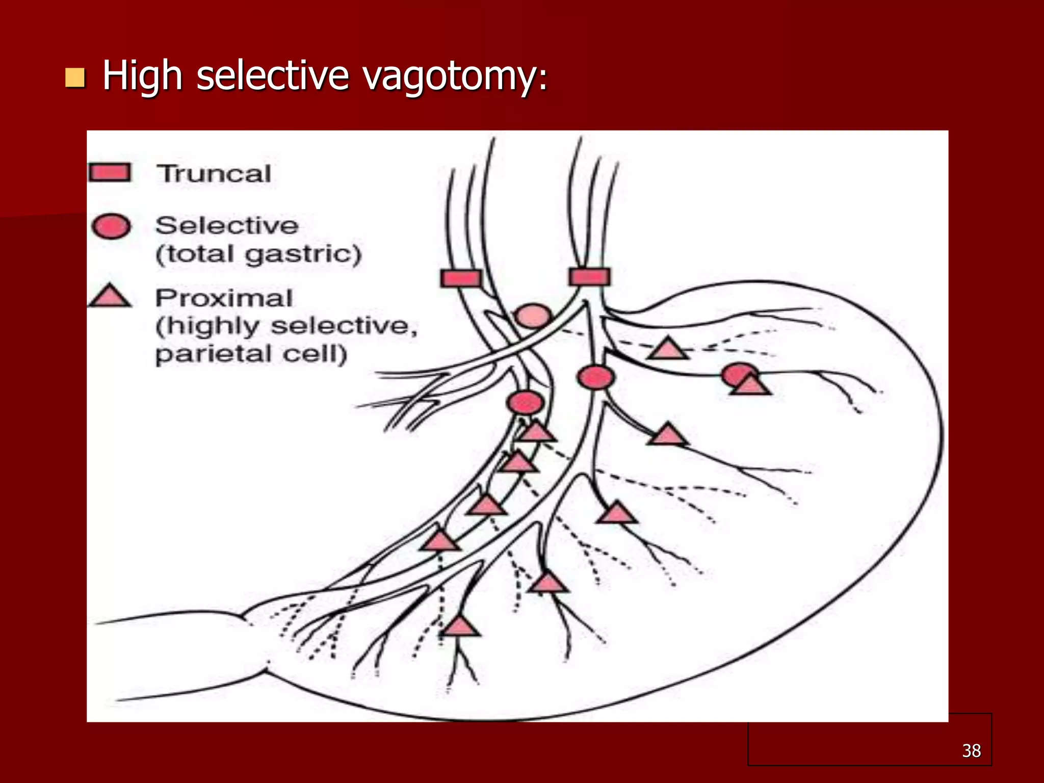 Peptic ulcer and duodenal ulcer ppt2 | PPT