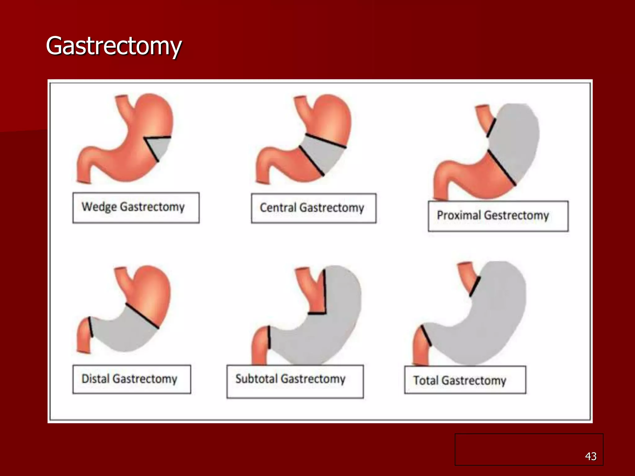 Peptic ulcer and duodenal ulcer ppt2 | PPT