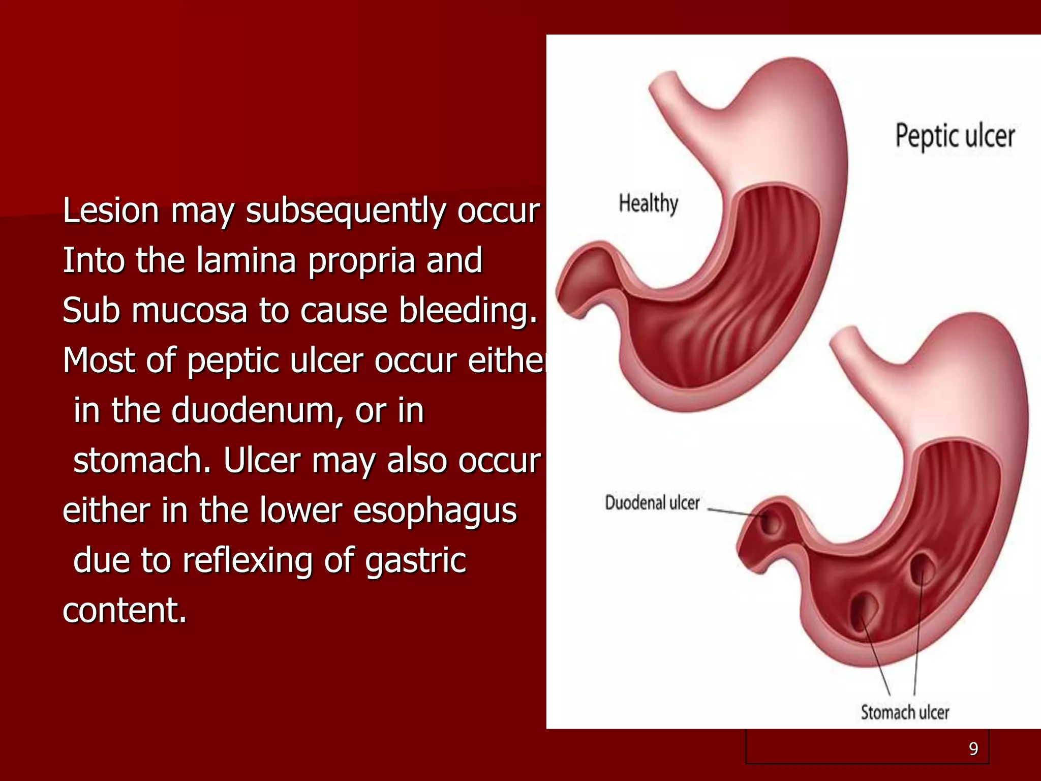 Peptic ulcer and duodenal ulcer ppt2 | PPT