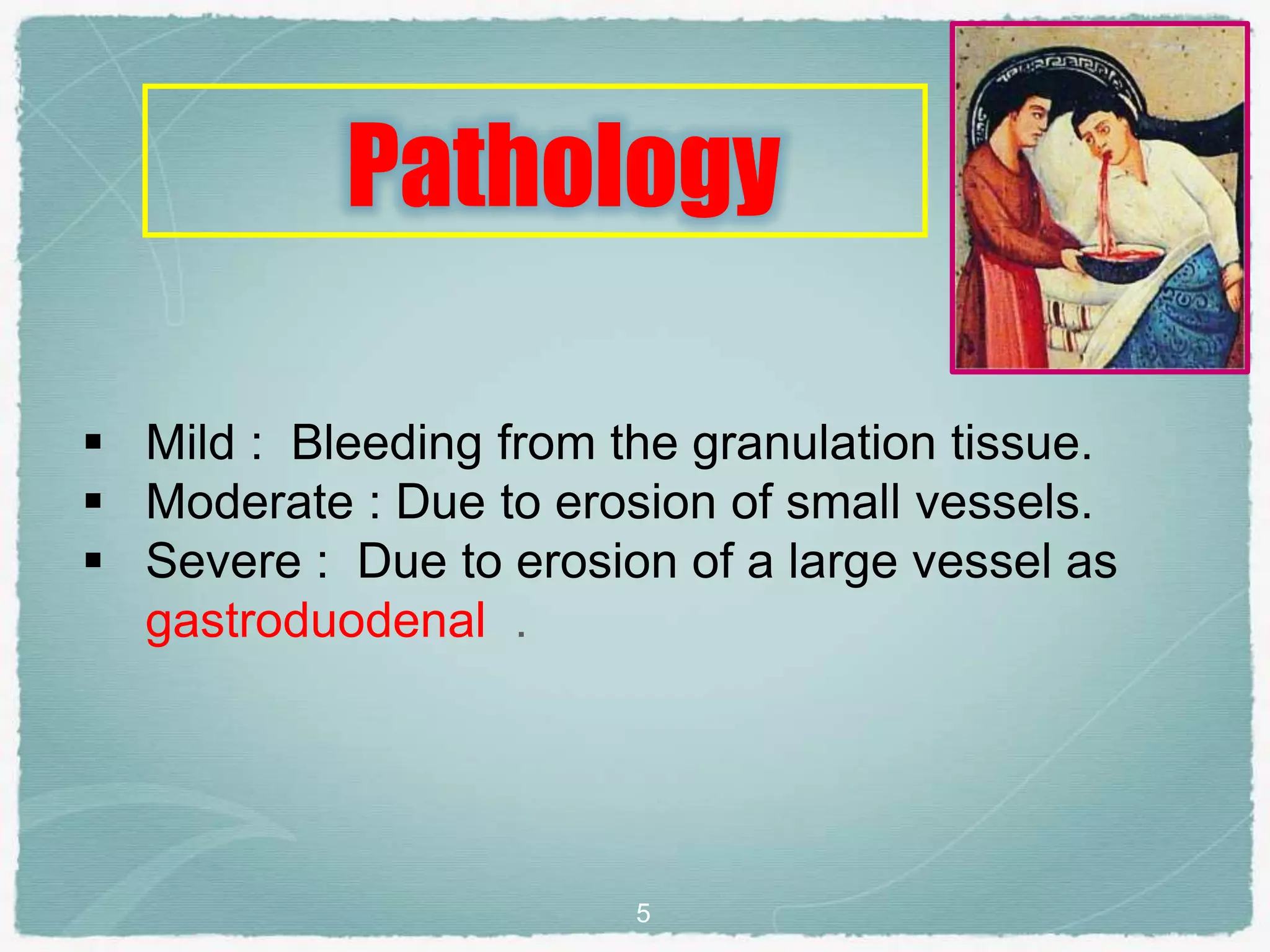 Peptic ulcer complications | PPTX