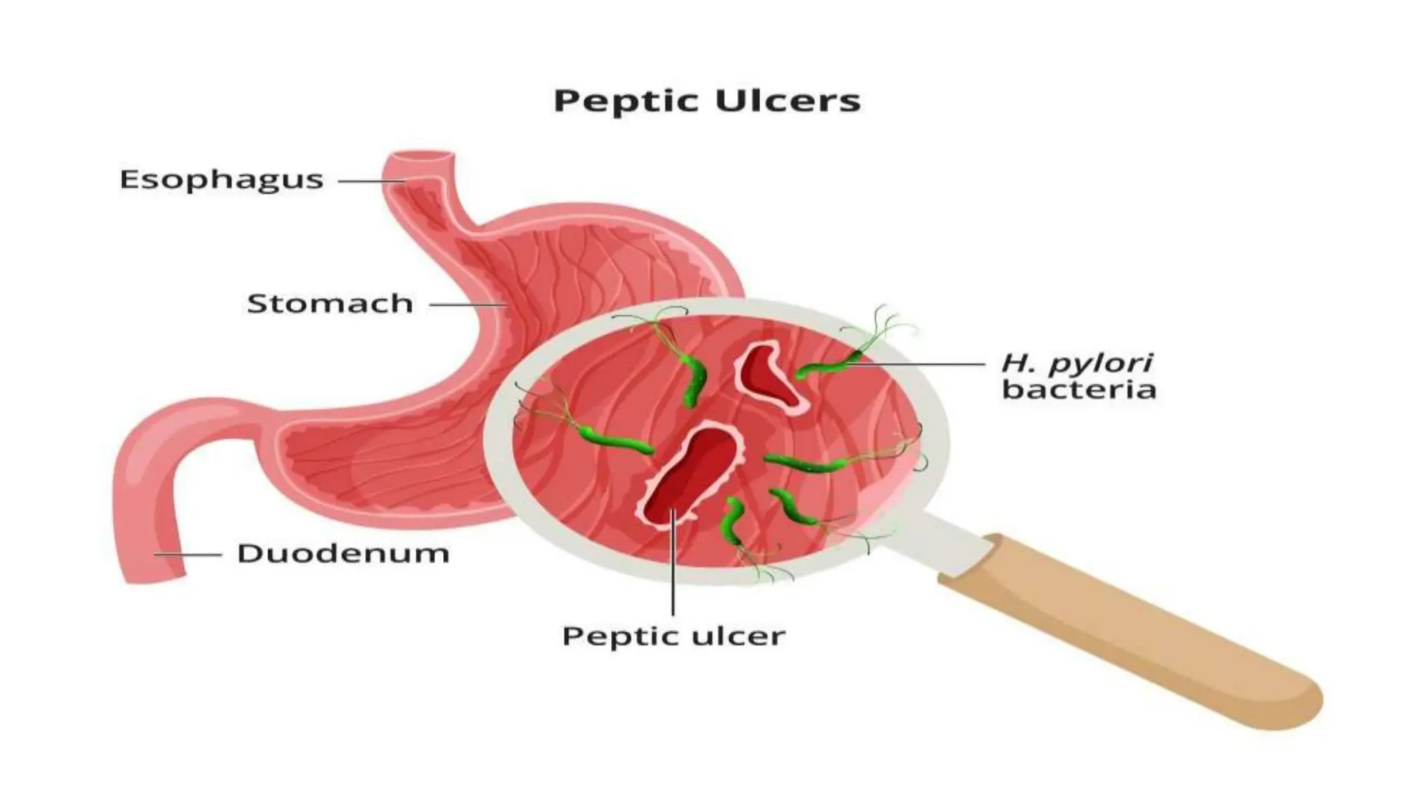 Peptic Ulcer complications By Abdullah Farooqi GM20-148.pptx