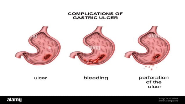 Peptic Ulcer complications By Abdullah Farooqi GM20-148.pptx