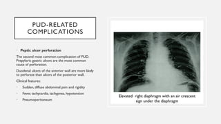 Peptic ulcer, diagnostics and management 1.pptx