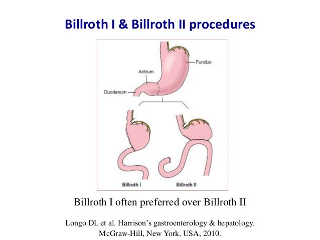 Billroth 1 Versus 2 Procedure