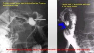 Upper Gi Series Ulcer
