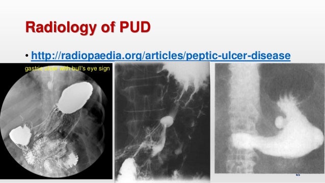 Peptic ulcer disease, upper gastrointestinal tract bleeding management
