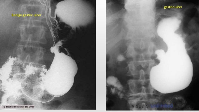 Upper Gi Series Ulcer