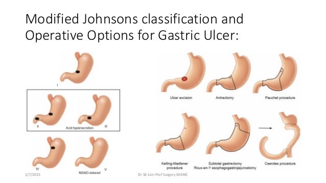 Peptic ulcer disease