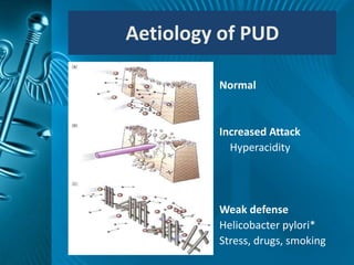 Peptic Ulcer Disease by Dr. Sookun Rajeev Kumar M.D | PPTX