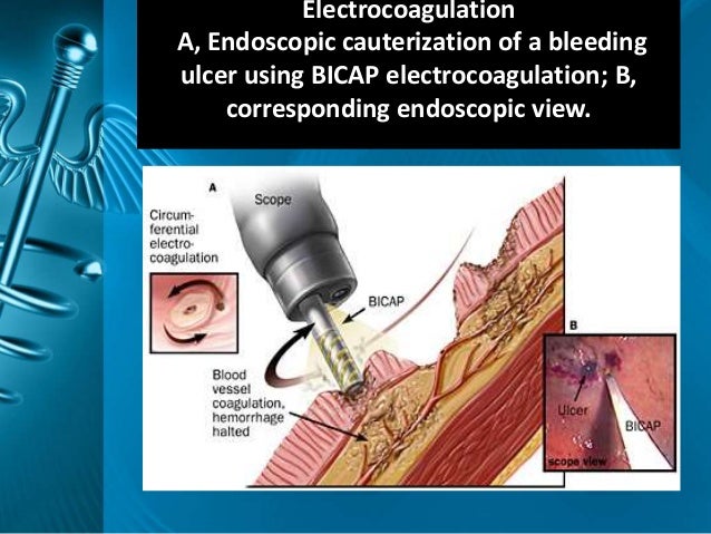 Peptic Ulcer Disease by Dr. Sookun Rajeev Kumar M.D