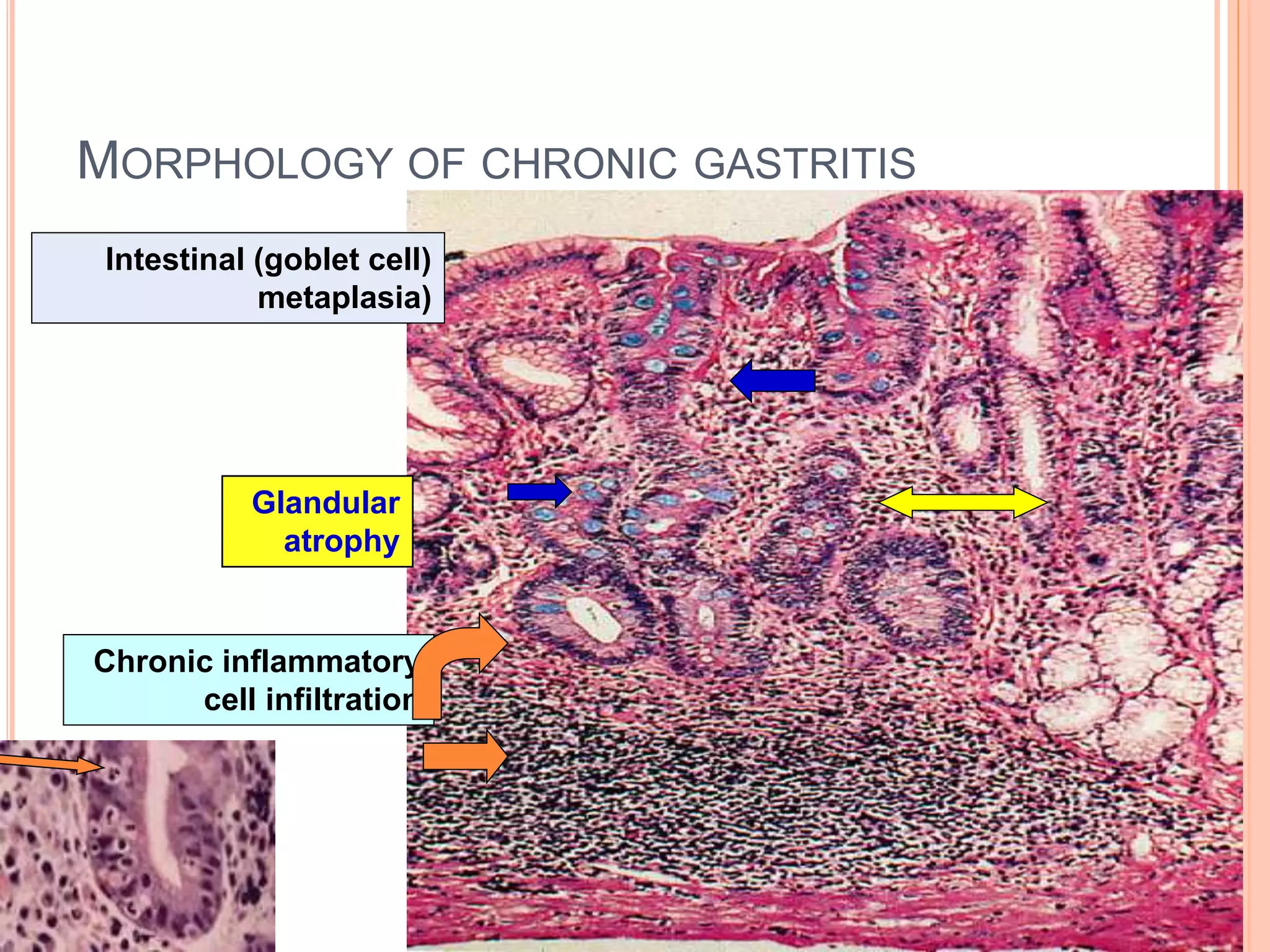 Peptic ulcer disease | PPTX