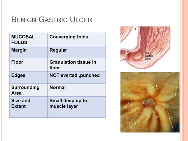 Peptic ulcer disease