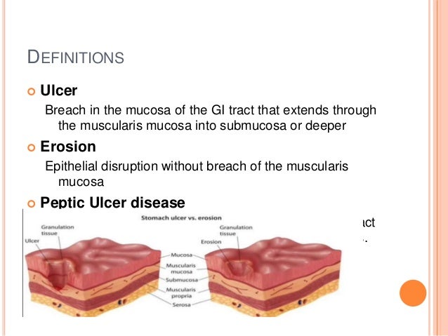 Peptic ulcer disease
