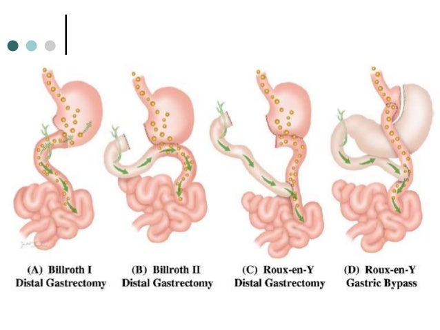 Gastric Bypass Billroth I Versus Billroth Ii Anatomy