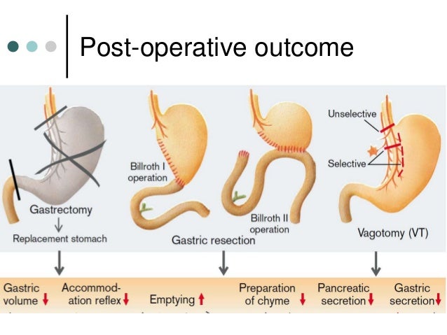 Peptic ulcer disease