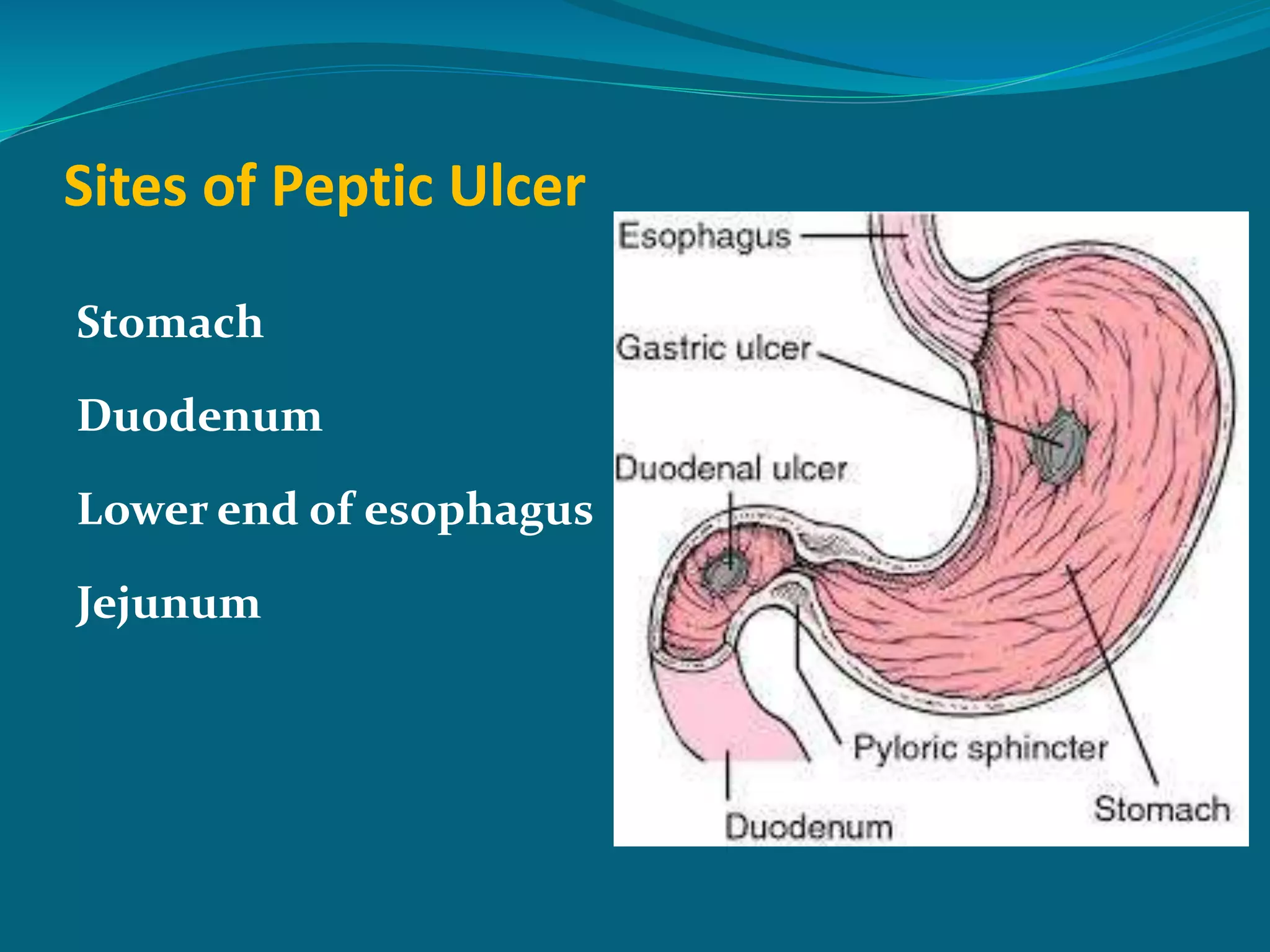 Peptic ulcer disease | PPTX
