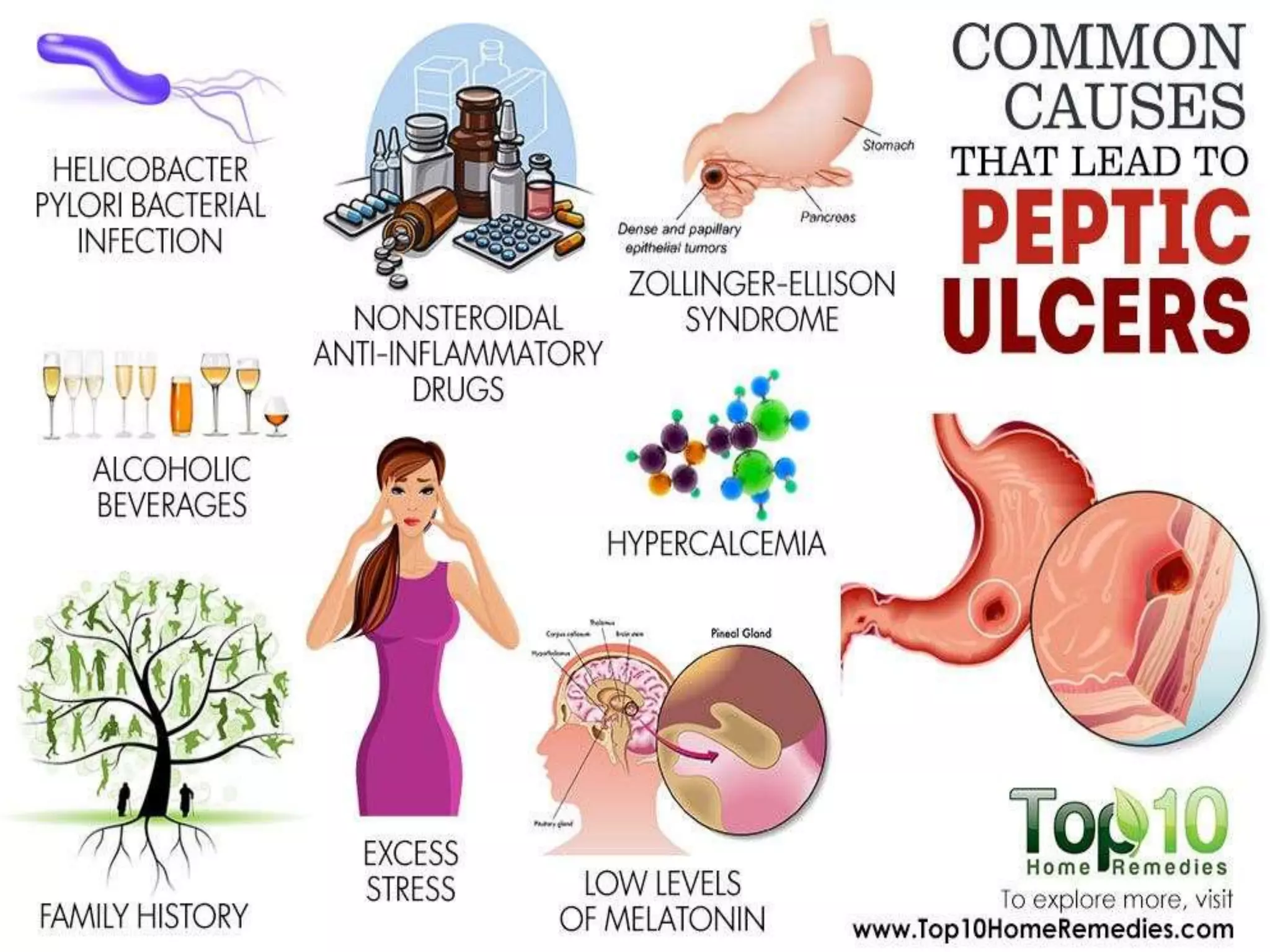 Peptic ulcer disease | PPTX