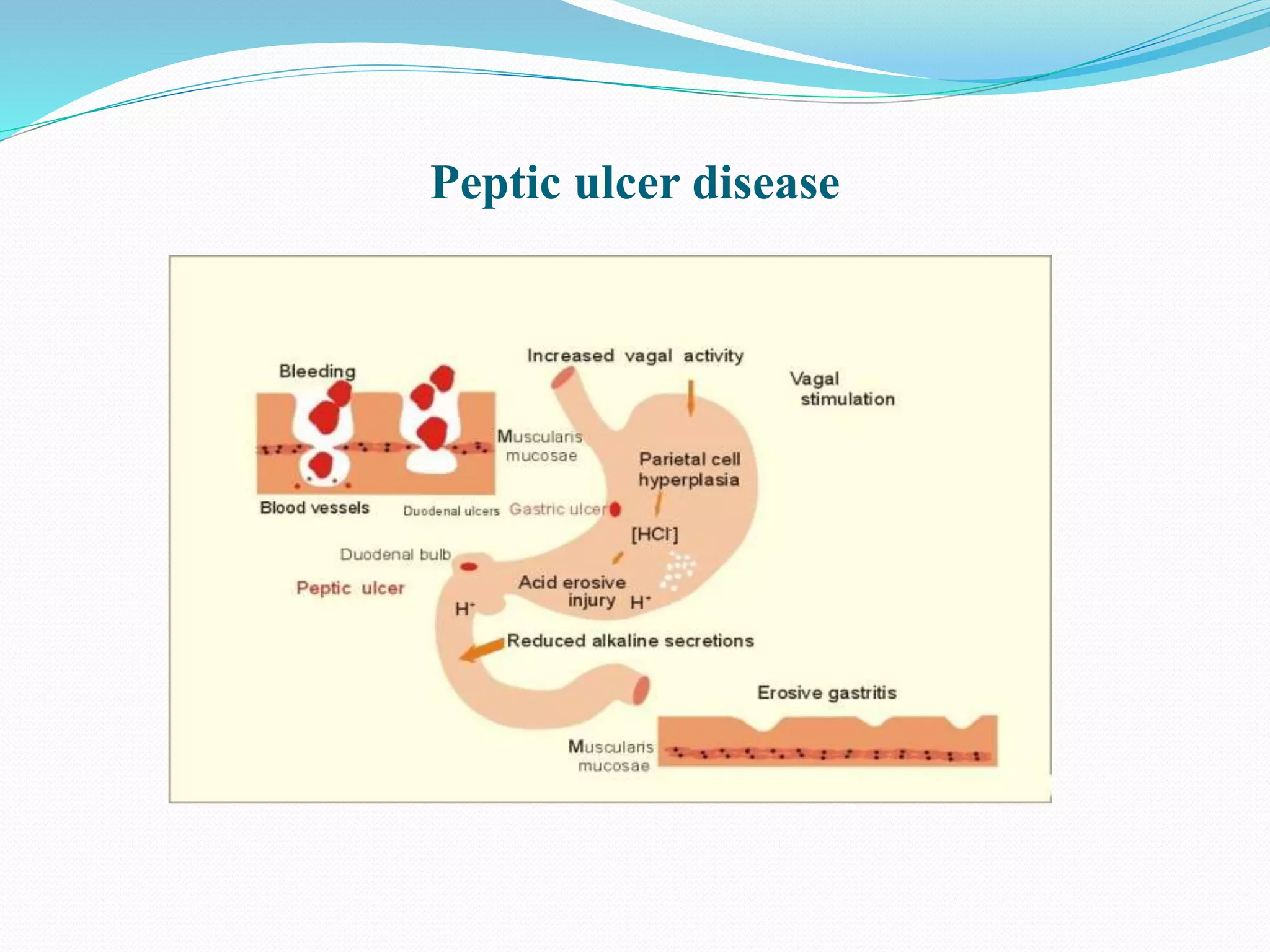 Peptic ulcer disease | PPTX