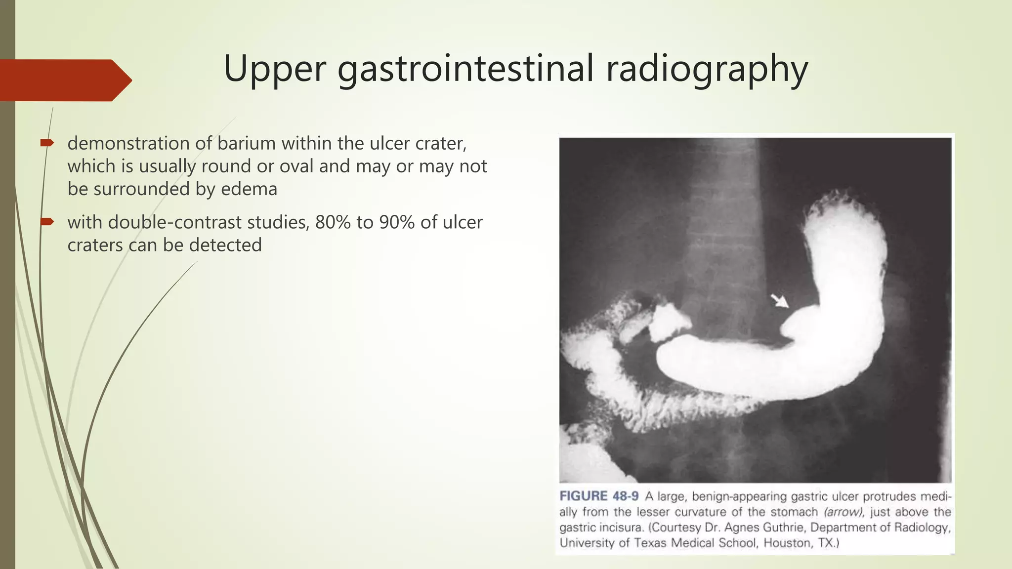 Peptic ulcer disease | PPTX