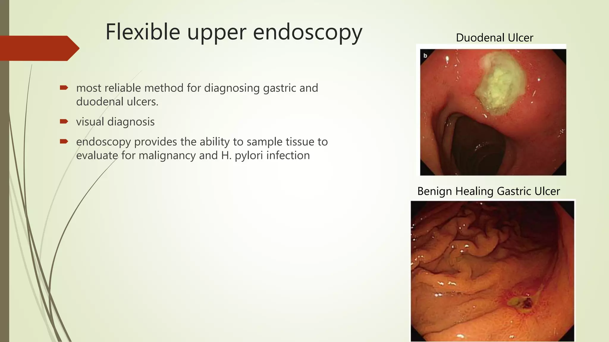 Peptic ulcer disease | PPTX