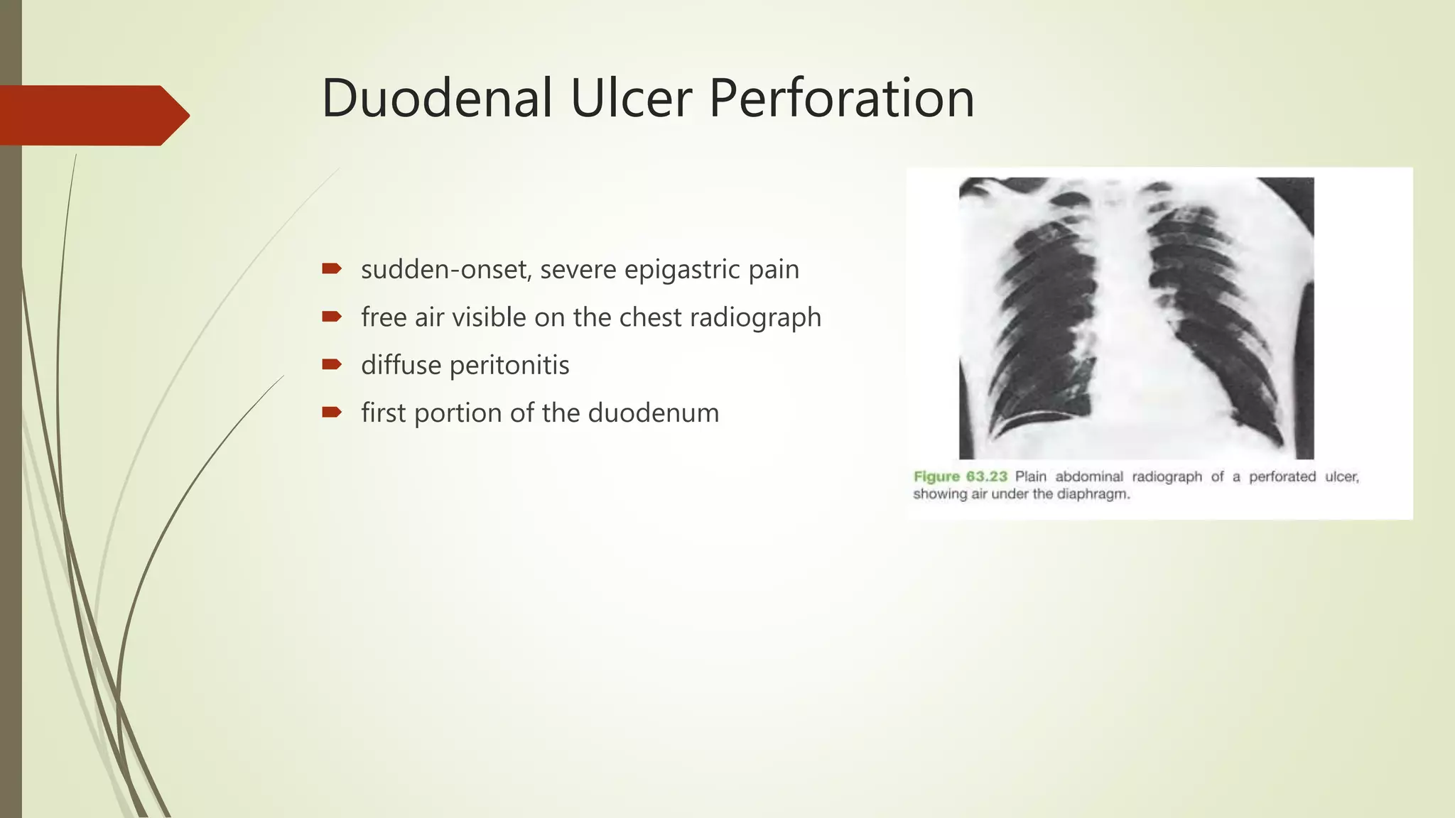 Peptic ulcer disease | PPTX