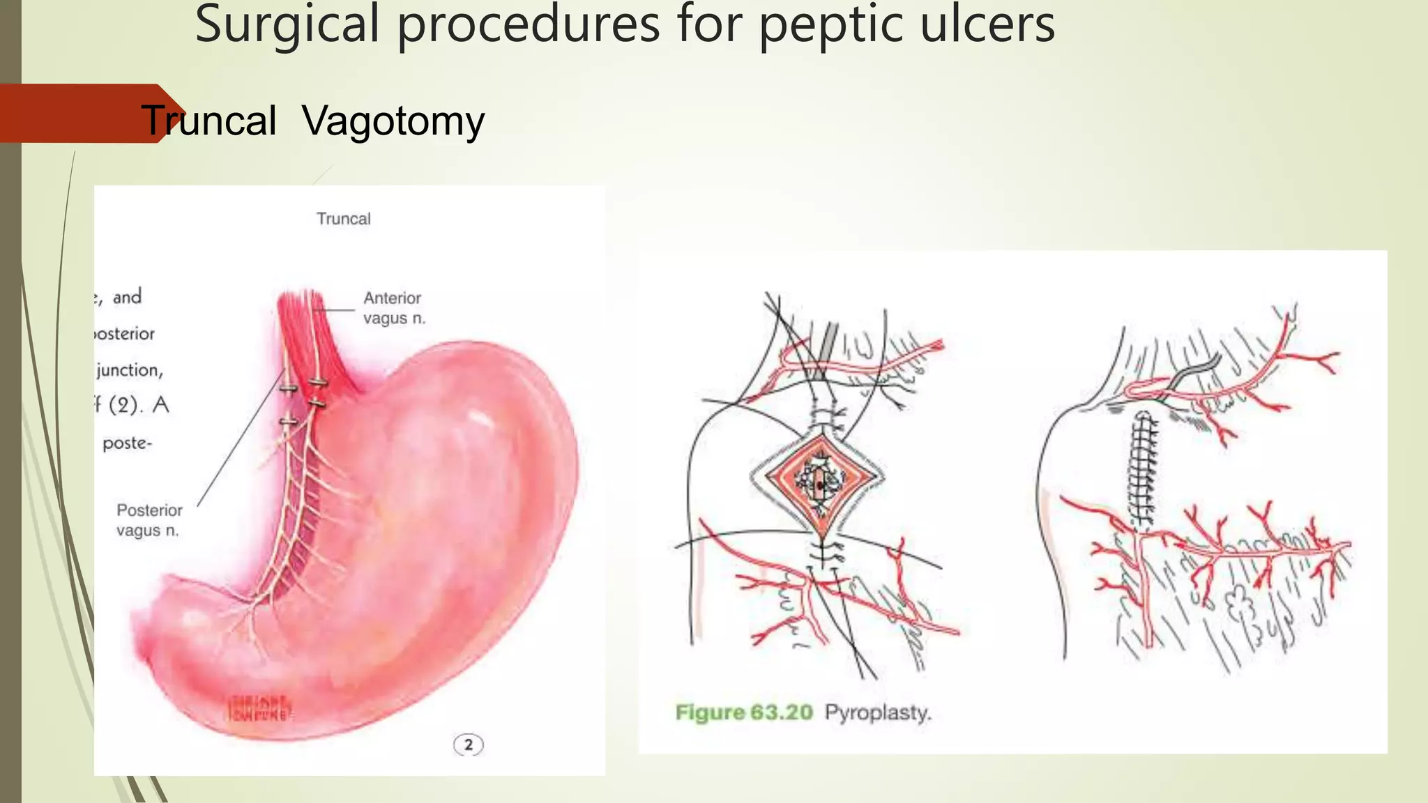 Peptic ulcer disease | PPTX