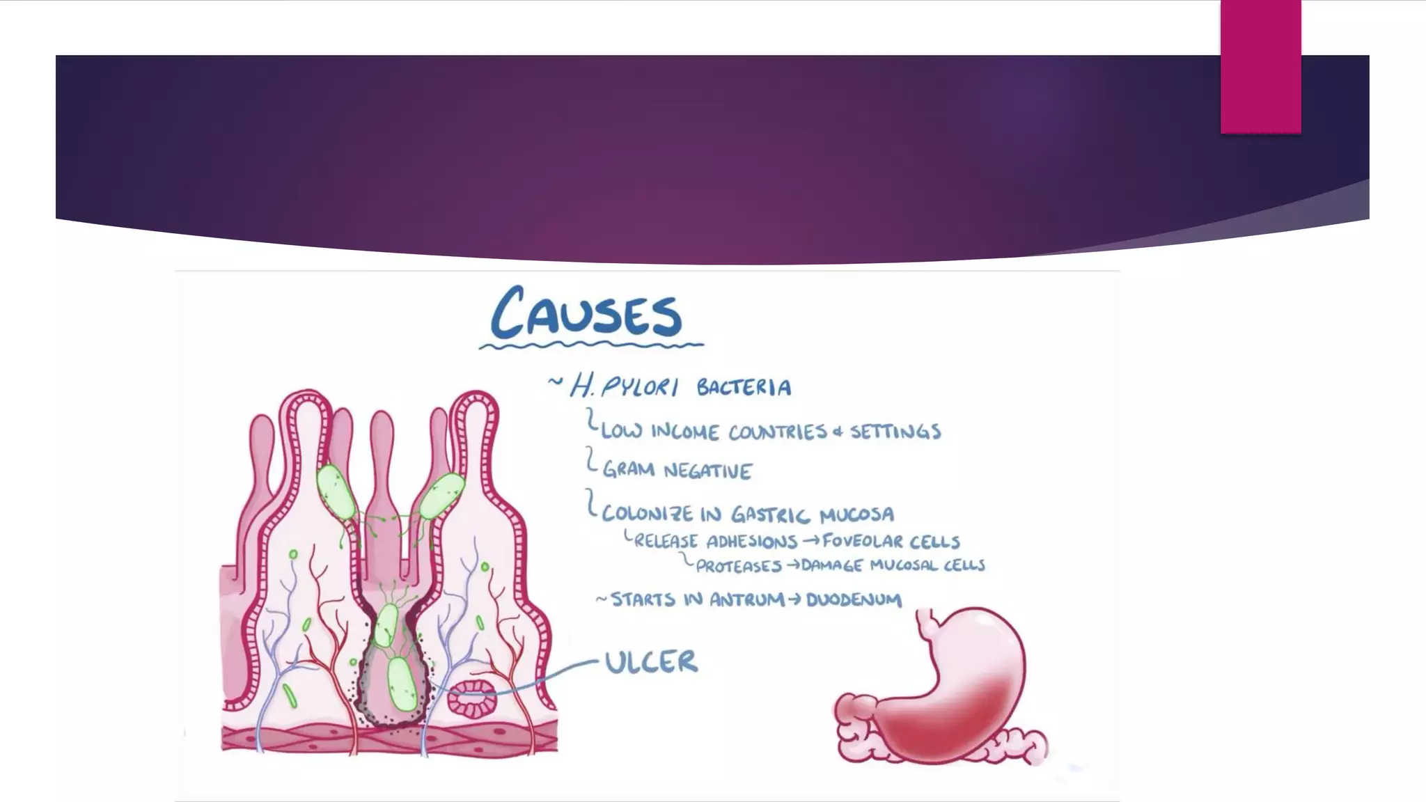 Peptic ulcer disease (PUD) | PDF