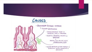 Peptic ulcer disease (PUD) | PDF