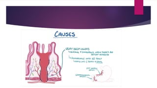 Peptic ulcer disease (PUD) | PDF