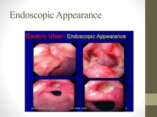 Peptic ulcer disease | PPT