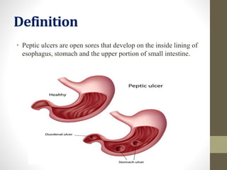 Peptic ulcer disease | PPT