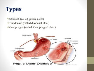 Peptic ulcer disease | PPT